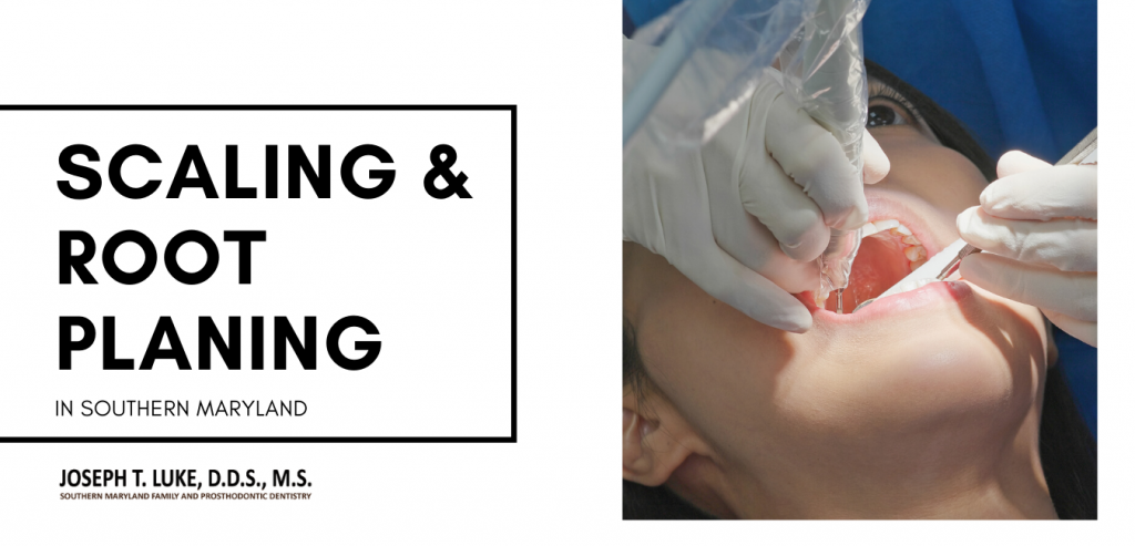 Scaling and Root Planing